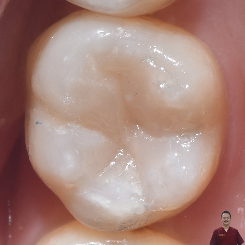 Penambalan Gigi - Janji Dental