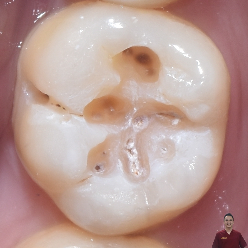 Penambalan Gigi - Janji Dental