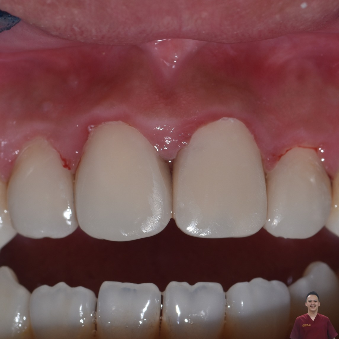 Penambalan Gigi - Janji Dental