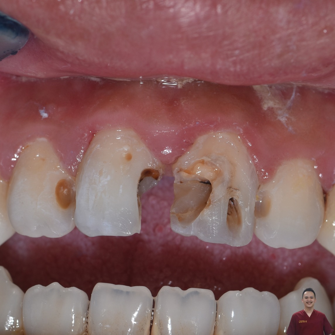 Penambalan Gigi - Janji Dental