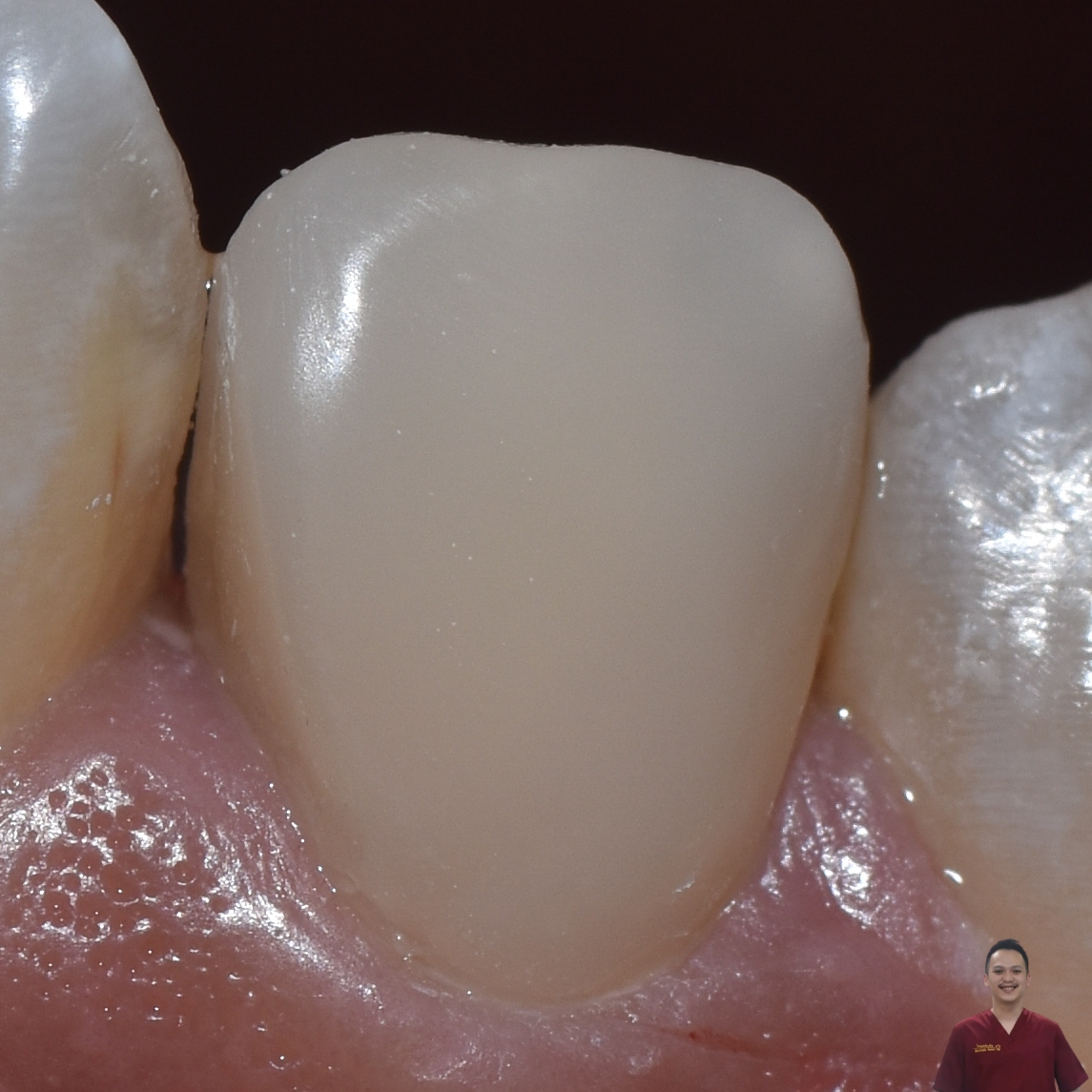 Penambalan Gigi - Janji Dental