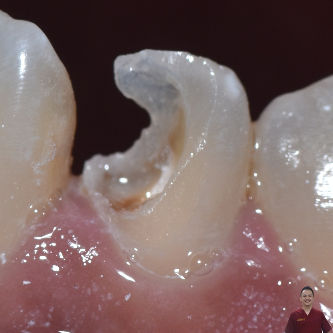 Penambalan Gigi - Janji Dental